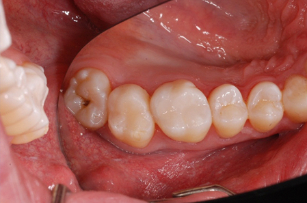 Leaking Amalgam Fillings Case Study | Care 4 Smiles